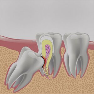 Tooth Infection Treatment, Wisdom Tooth & Root Canal Infection